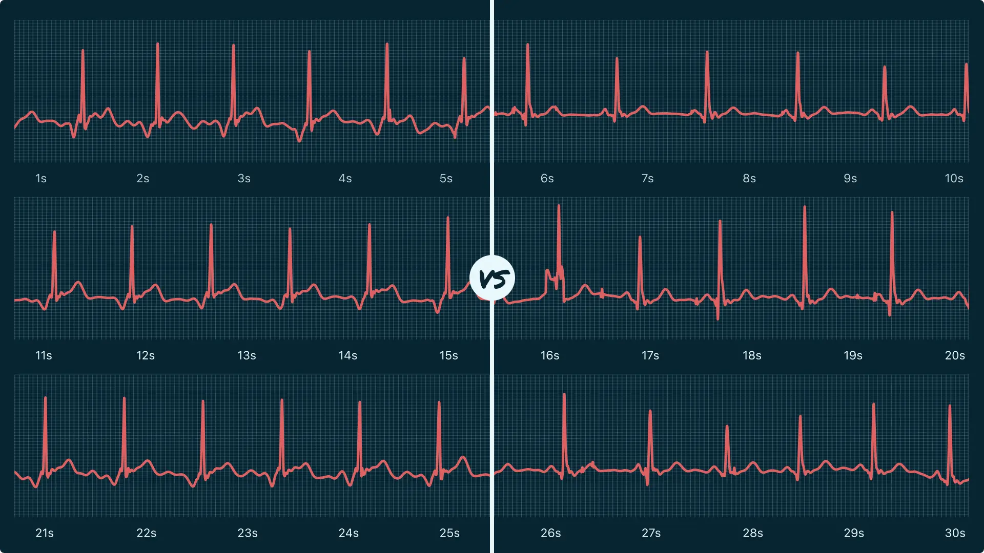 Junctional Rhythm Vs Sinus Rhythm On Your Watch Ecg Qaly